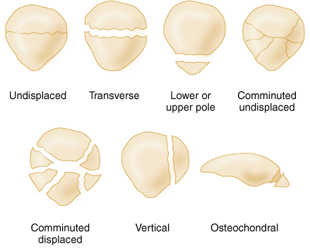 슬개골 골절(patella fractrue)[정자동필라테스:분당 재활운동 체형교정전문 편안한움직임] : 네이버 블로그