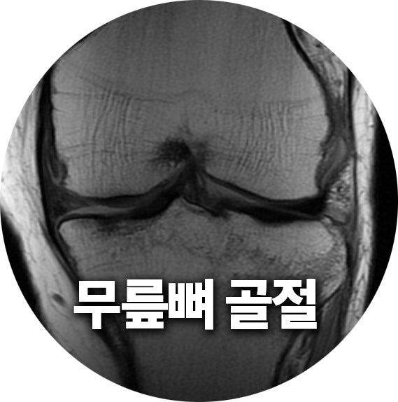 무릎뼈 골절 후유장해 보험금 청구 보상전문가 네이버 블로그
