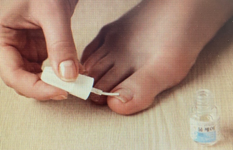 발톱무좀풀케어 사용법과 발톱무좀약 총정리원케어 로푸록스네일라카 로세릴네일라카 네이버 블로그