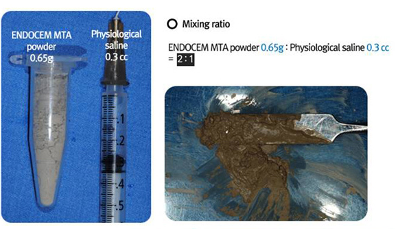 Endocem MTA by Maruchi (엠티에이) : 네이버 블로그