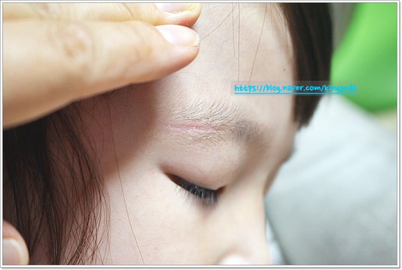 아이 흉터제거연고 스카이지겔 상처자국 연하게 도와줘요. : 네이버 블로그