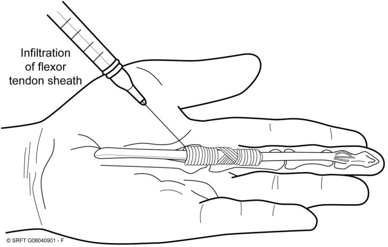 A1 pulley release [Trigger finger] : 네이버 블로그