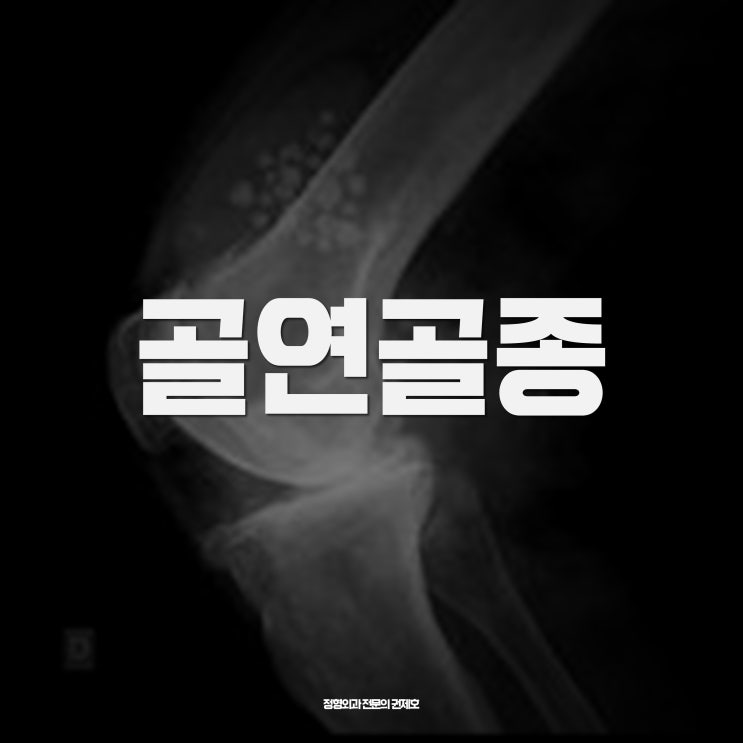 관절경을 이용한 슬관절내 골연골종 치료 Feat 권제호무릎수술일지