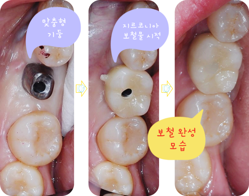 봉담 치과 임플란트 Case 연세서울미래치과의 뼈이식골유도재생술 임플란트 증례 네이버 블로그