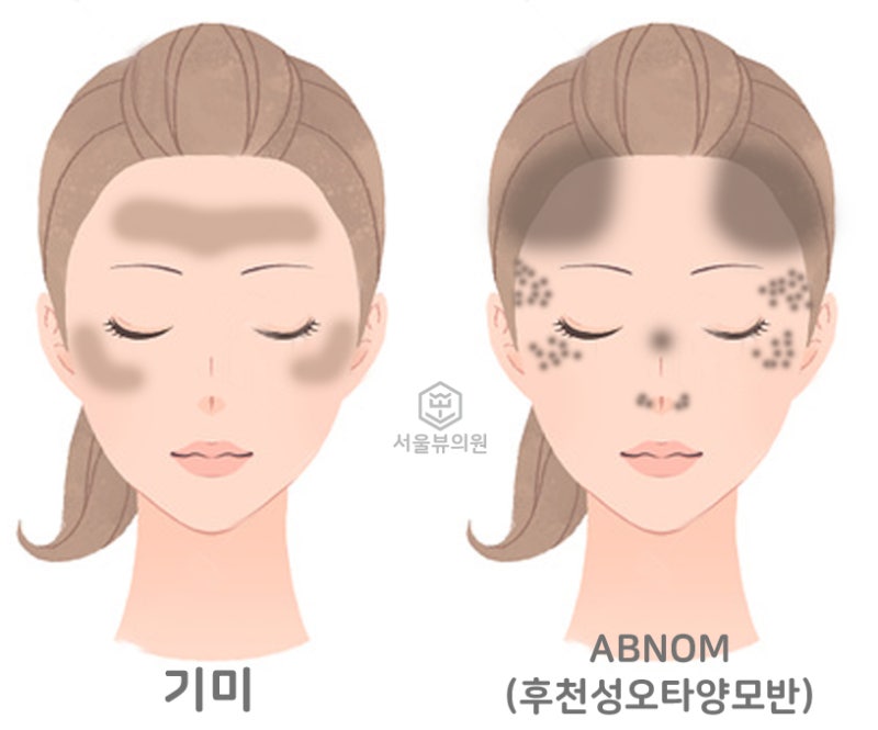 기미와 ABNOM(어브넘, 후천성오타양모반) 구분하기 : 네이버 블로그