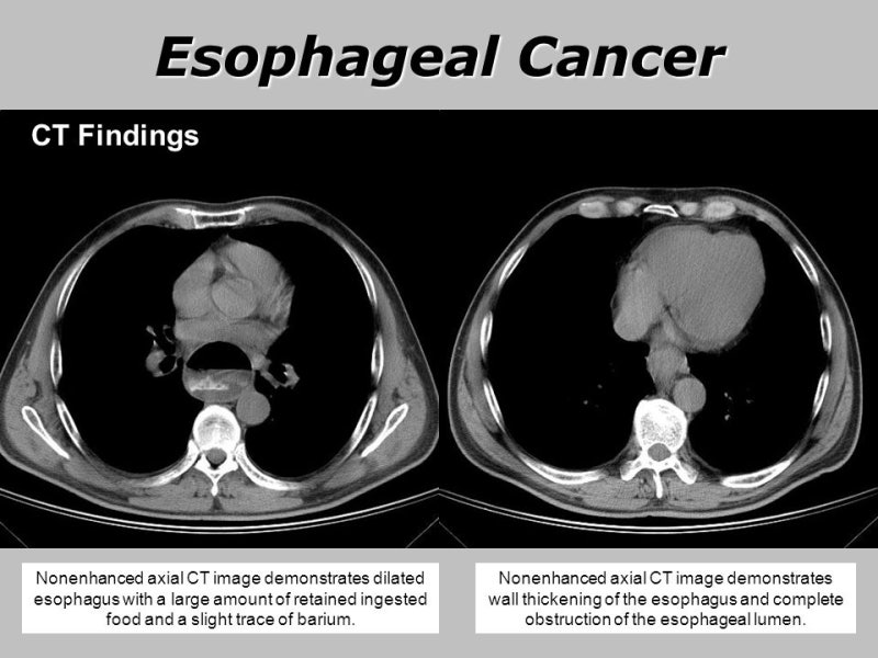 식도암의 진단과 검사(diagnosis of esophageal cancer) : 네이버 블로그