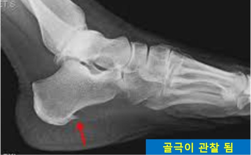 족저근막염 원인부터 족부병원의 진단과 치료까지 네이버 블로그