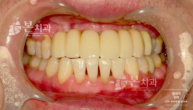 임플란트 케이스 돌아보기 아산치과더 프리미엄 본 치과의 아산임플란트 케이스 타치과에서 실패한 임플란트 복원하기 네이버 블로그