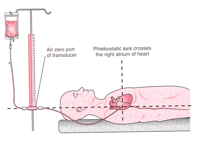 [Rn] 중심정맥관 Central venous catheter,CVP (C-line, Hickman, Mac catheter ...