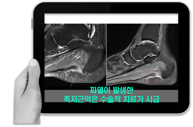 족저근막염 원인부터 족부병원의 진단과 치료까지 네이버 블로그