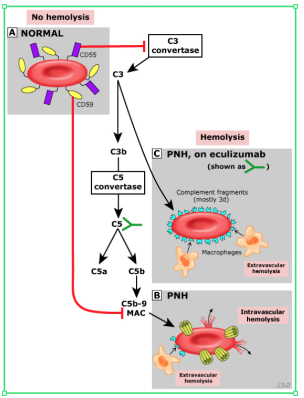 [Hematology] Paroxysmal Nocturnal Hemoglobinuria (PNH), Eculizumab and ...