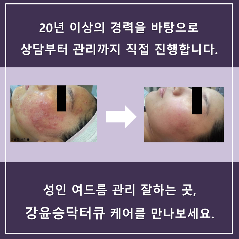 강윤승 여드름관리 A14