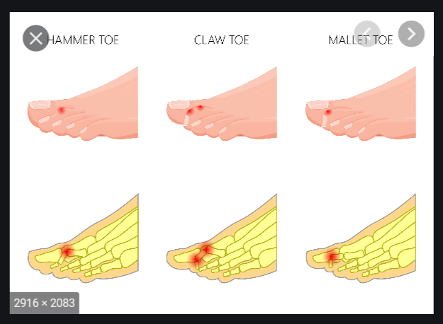 Gait Cycle 걸음주기 비정상보행 네이버 블로그