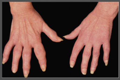 [Rheumatology] Bouchard's node, Heberden's node : 네이버 블로그