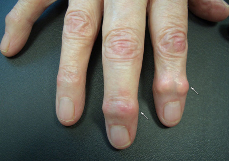 [Rheumatology] Bouchard's node, Heberden's node : 네이버 블로그
