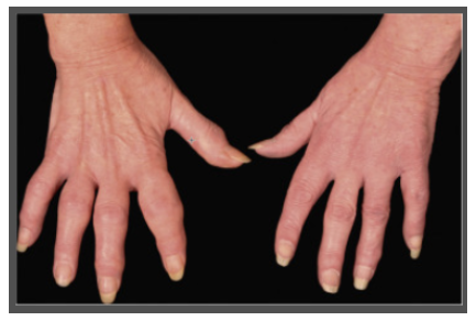 [Rheumatology] Bouchard's node, Heberden's node : 네이버 블로그