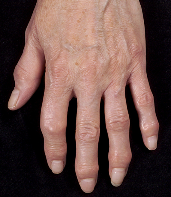 [Rheumatology] Bouchard's node, Heberden's node : 네이버 블로그