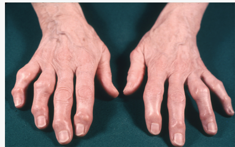 [Rheumatology] Bouchard's node, Heberden's node : 네이버 블로그