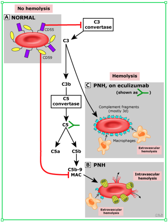 [Hematology] Paroxysmal Nocturnal Hemoglobinuria (PNH), Clinical ...