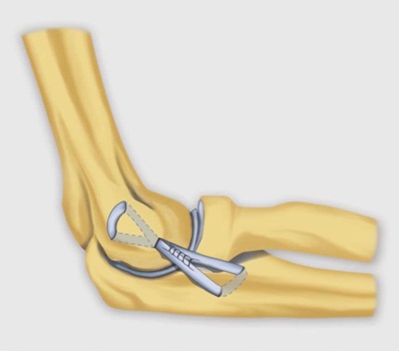 팔꿈치 외측인대파열 및 후외측 불안정성 (LUCL rupture with PLRI) : 네이버 블로그