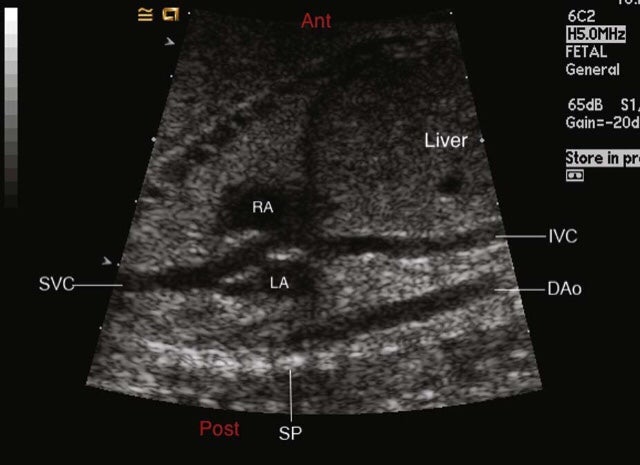 Q41.태아 심장 초음파 시 보는 구조물,좌심실, 좌심방,우심실, 우심방, 폐동맥,대동맥,하대정맥, 상대정맥 등 자세히 보기 ...