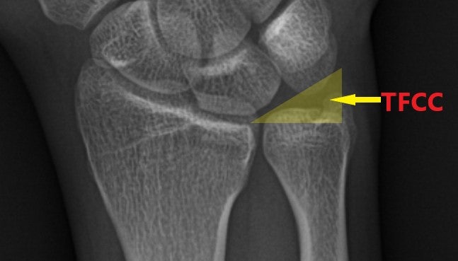 손목 삼각연골복합체(Triangular fibrocartilage complex, TFCC) 손상 및 척골충돌증후군 (Ulnar ...