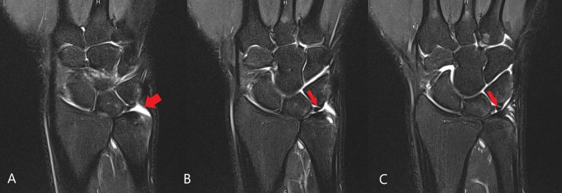 손목 삼각연골복합체(Triangular fibrocartilage complex, TFCC) 손상 및 척골충돌증후군 (Ulnar ...
