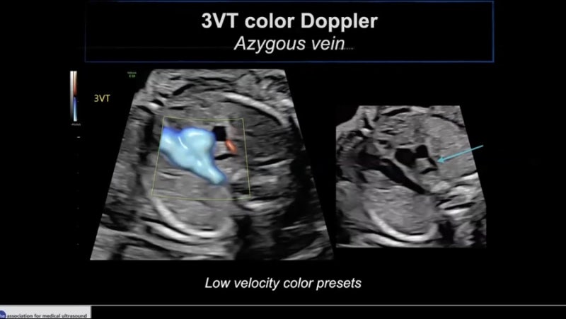 Q42.Fetal 3 vessel views/ 16번째 AIUM 합격 인증서와 태아 초음파 강의 요약 : 네이버 블로그