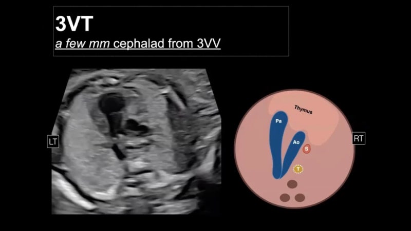 Q42.Fetal 3 vessel views/ 16번째 AIUM 합격 인증서와 태아 초음파 강의 요약 : 네이버 블로그