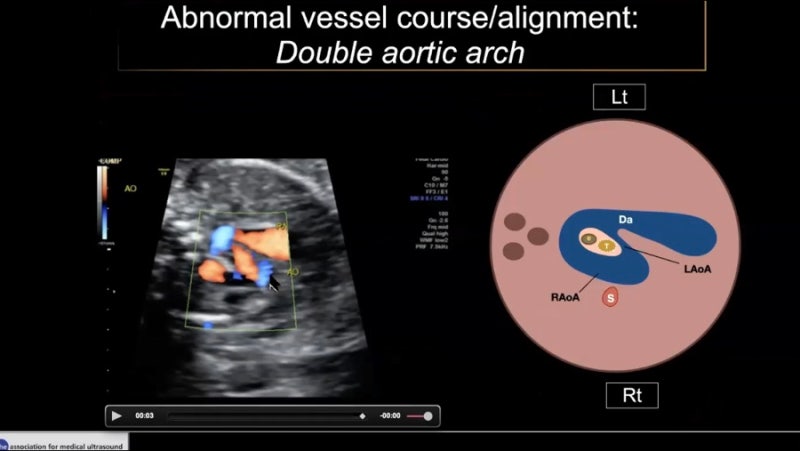 Q42.Fetal 3 vessel views/ 16번째 AIUM 합격 인증서와 태아 초음파 강의 요약 : 네이버 블로그