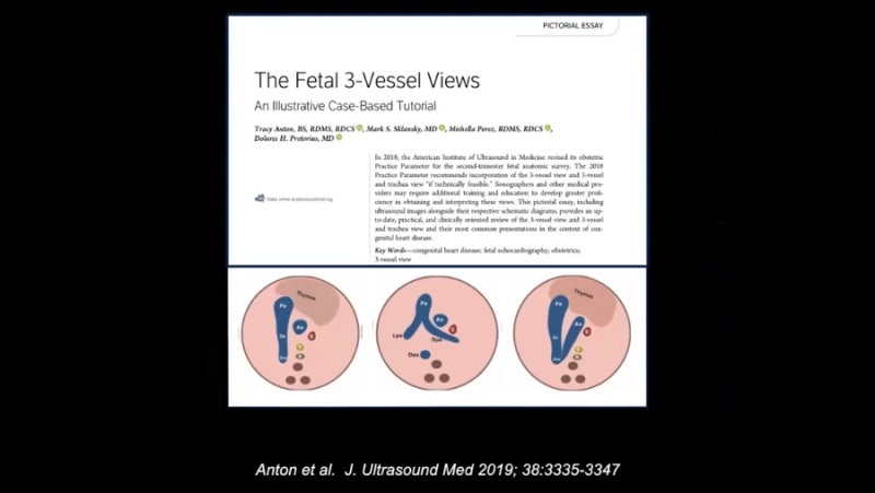 Q42.Fetal 3 vessel views/ 16번째 AIUM 합격 인증서와 태아 초음파 강의 요약 : 네이버 블로그