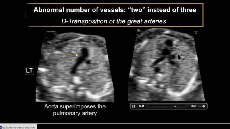 Q42.Fetal 3 vessel views/ 16번째 AIUM 합격 인증서와 태아 초음파 강의 요약 : 네이버 블로그
