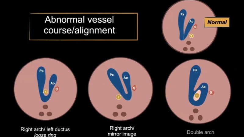 Q42.Fetal 3 vessel views/ 16번째 AIUM 합격 인증서와 태아 초음파 강의 요약 : 네이버 블로그