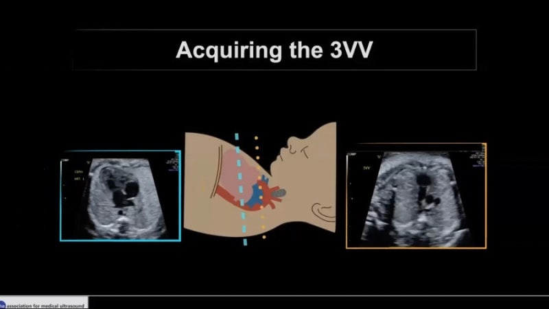 Q42.Fetal 3 vessel views/ 16번째 AIUM 합격 인증서와 태아 초음파 강의 요약 : 네이버 블로그