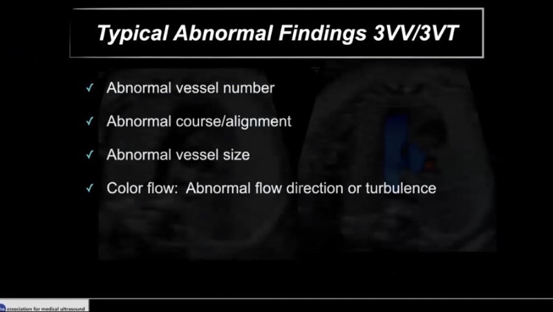 Q42.Fetal 3 vessel views/ 16번째 AIUM 합격 인증서와 태아 초음파 강의 요약 : 네이버 블로그