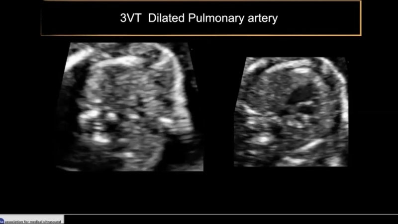 Q42.Fetal 3 vessel views/ 16번째 AIUM 합격 인증서와 태아 초음파 강의 요약 : 네이버 블로그