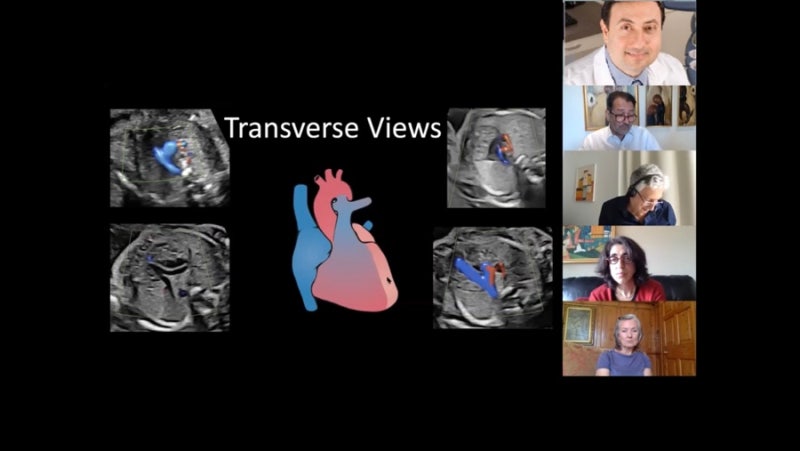 Q43.TOF의 다양한 분류와 TGA 강의/Alfred Abuhamad 의 Abnormal outflow tract 와 3VV ...