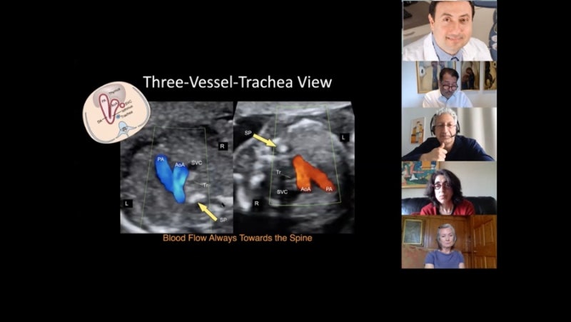Q43.TOF의 다양한 분류와 TGA 강의/Alfred Abuhamad 의 Abnormal outflow tract 와 3VV ...