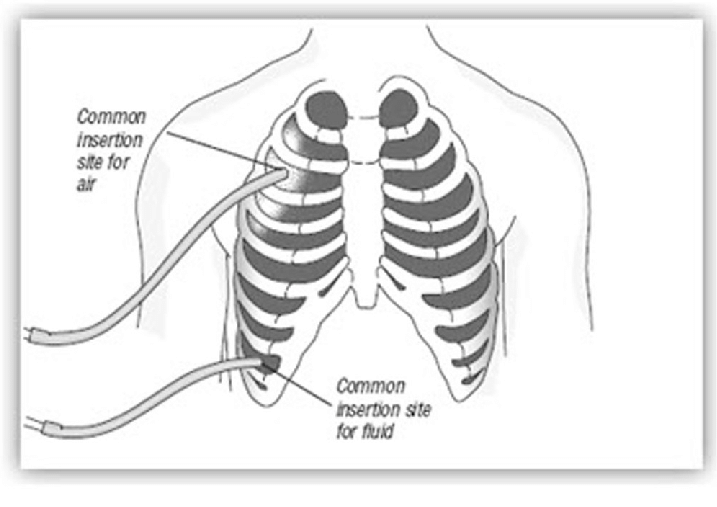 22. chest tube(흉관튜브 간호) : 네이버 블로그