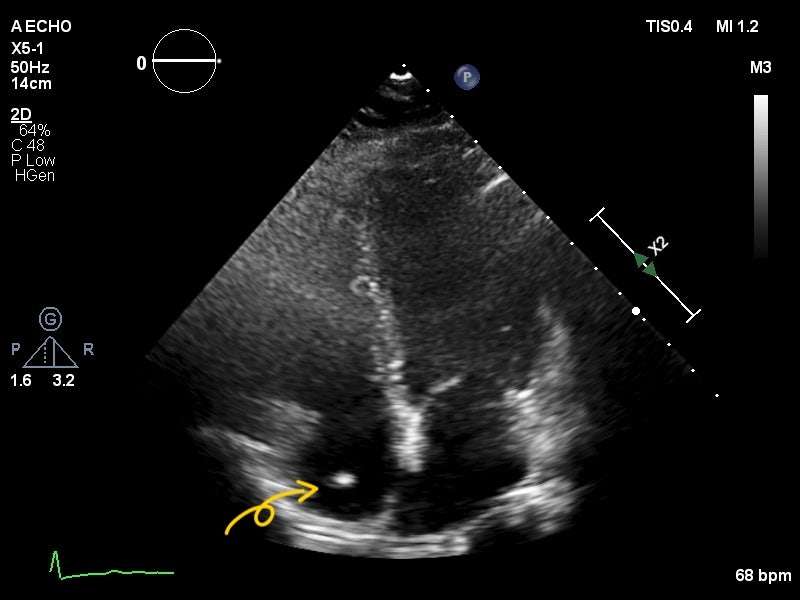 Normal variants of right atrium : 네이버 블로그