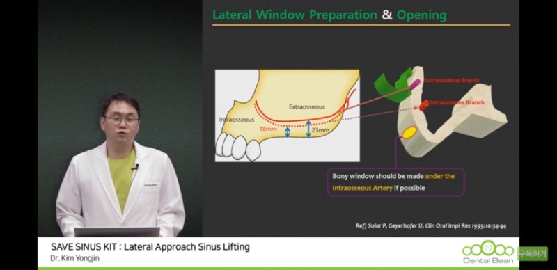 Save sinus kit by dentis를 이용한 lateral approach - 김용진 원장님 : 네이버 블로그