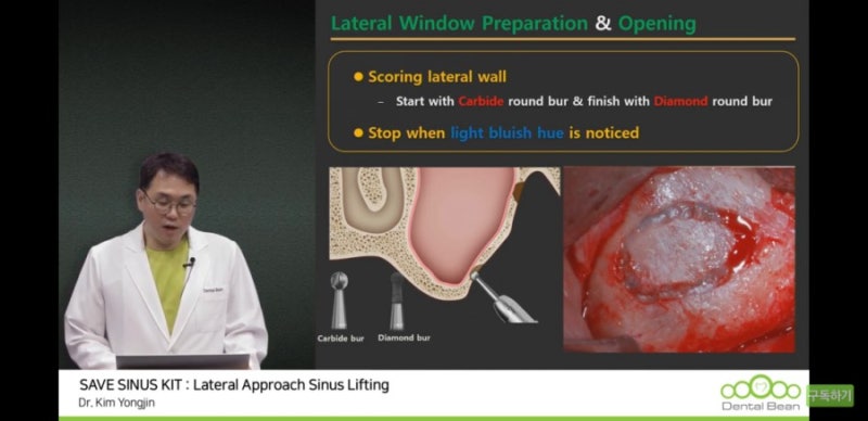 Save sinus kit by dentis를 이용한 lateral approach - 김용진 원장님 : 네이버 블로그
