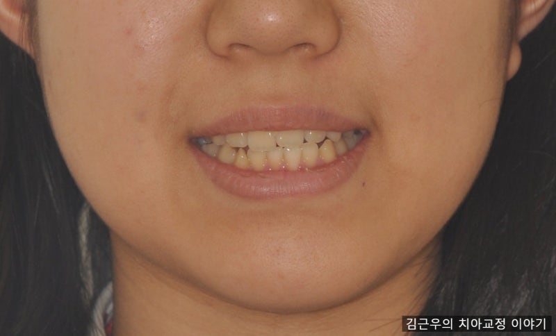 안면 비대칭 치아교정으로 개선할 수 있나요 네이버 블로그