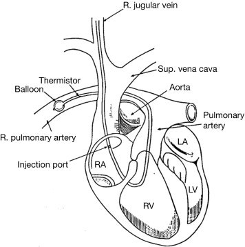 Swan-Ganz catheter / Rt. heart cath. : 네이버 블로그