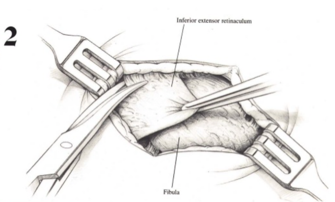 Ankle MBO(Modified Brostrom Operation) - 발목 인대 봉합술 : 네이버 블로그