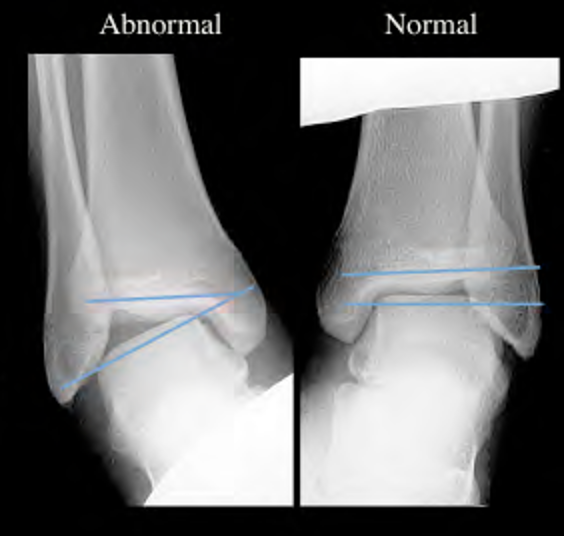 Ankle MBO(Modified Brostrom Operation) - 발목 인대 봉합술 : 네이버 블로그