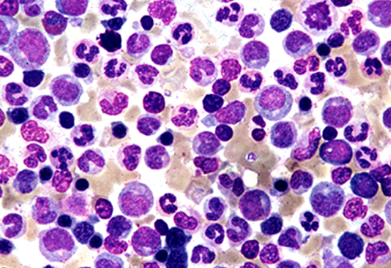 [Hematology] Peripheral blood of chronic myeloid leukemia (CML) : 네이버 블로그