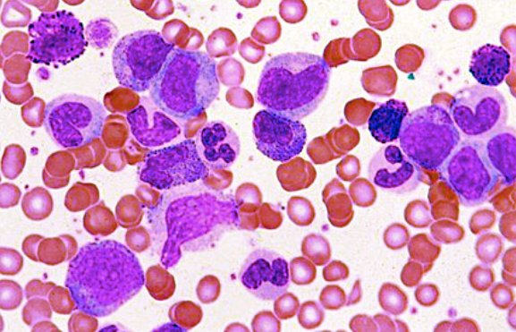 [Hematology] Peripheral blood of chronic myeloid leukemia (CML) : 네이버 블로그