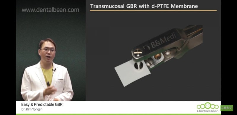 Save GBR kit by dentis - 김용진 원장님 : 네이버 블로그