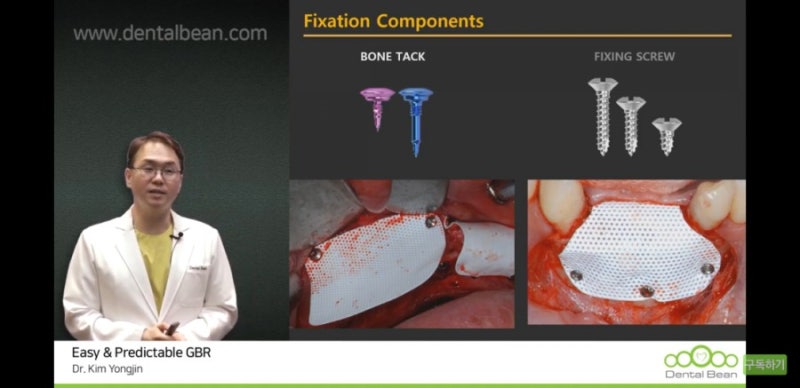 Save GBR kit by dentis - 김용진 원장님 : 네이버 블로그